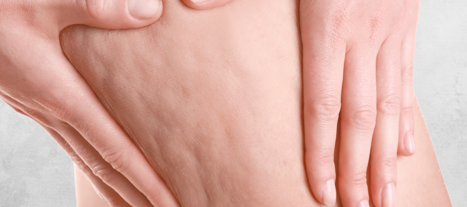 Cómo identificar los diferentes tipos de celulitis – Naturabel Chile